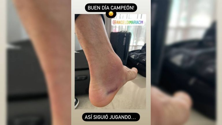 Impresionante: Di María mostró la imagen de su tobillo lastimado en la ...